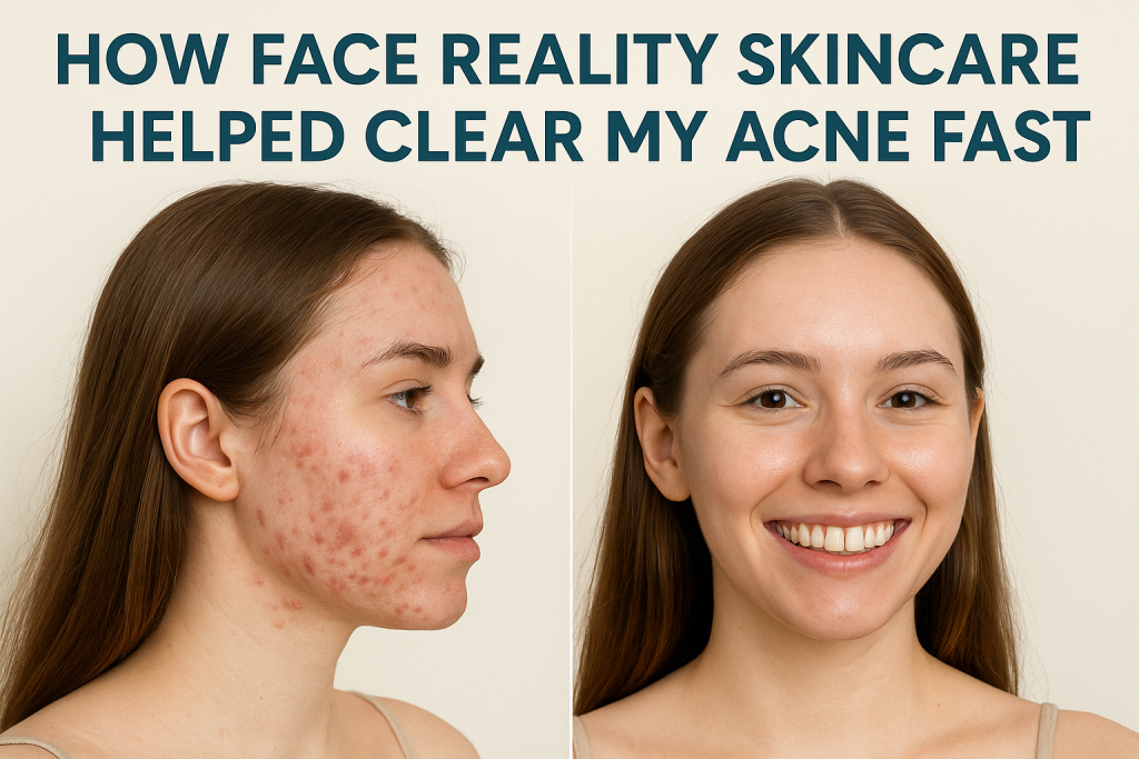 How Face Reality Skincare Helped Clear My Acne Fast